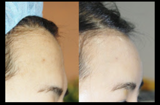 Cost and Before & After of Forehead Augmentation Surgery in Korea: What ...